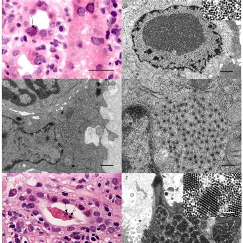 Renal Cortex With Viral Inclusions A Hematoxylin And Eosin Stained