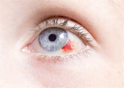 Corneal Abrasion What It Is Symptoms Risks And Treatment