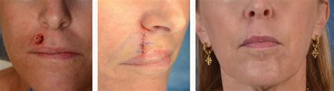 Simplifying Lip Reconstruction An Algorithmic Approach Pmc