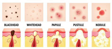 Papules And Pustules