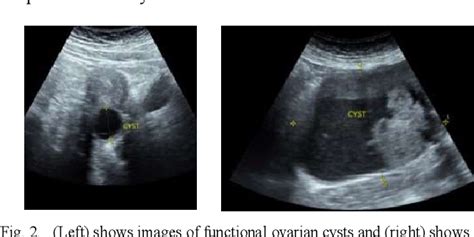 Figure 2 From Classification Of Ovarian Cysts On Ultrasound Images Using Watershed Segmentation