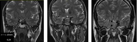Examples Of Gh Pitnet T2 Weighted Mri Intensity Classification From