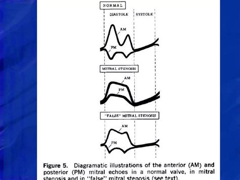 Echocardiographic Evaluation Of Mitral Valve Disease Pptx