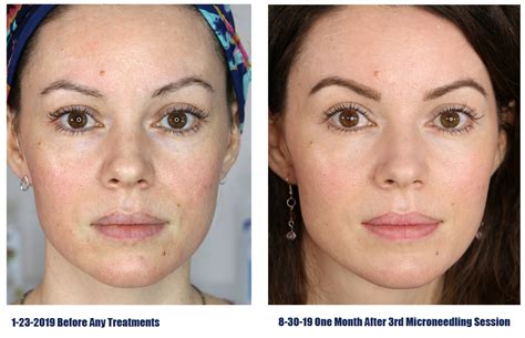 Before And After Micro Needling Qkoge