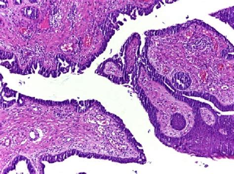 Projeção Papilar Em Detalhe Hande X100 Download Scientific Diagram