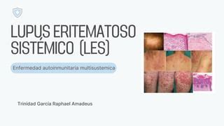 Lupus Eritematoso Sistémico Presenta Clínica Pdf