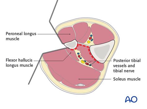 Approach To The Posterolateral Surface Of The Tibia Approach To The Posterolateral Surface Of The Tibia