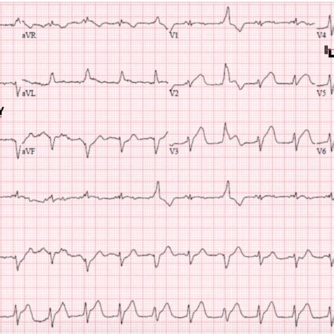 Pvcs Ecg Weekly