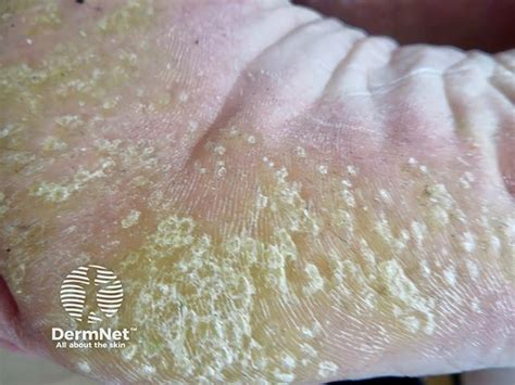 Punctate Palmoplantar Keratoderma Image