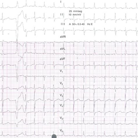 12 Lead Ecg Obtained During Sinus Rhythm Showing A Normal Pr Interval