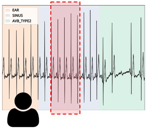 Cardiologist Level Arrhythmia Detection With Convolutional Neural Networks