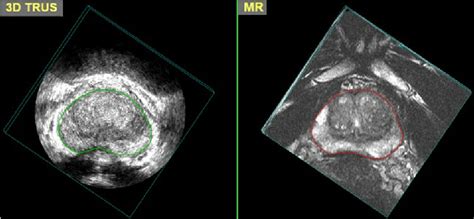 example of manually segmented contours on axial views in 3d trus images