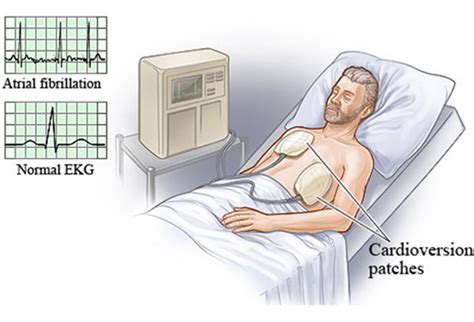 What Is Synchronized Cardioversion And How Does It Benefit Us New Health Advisor