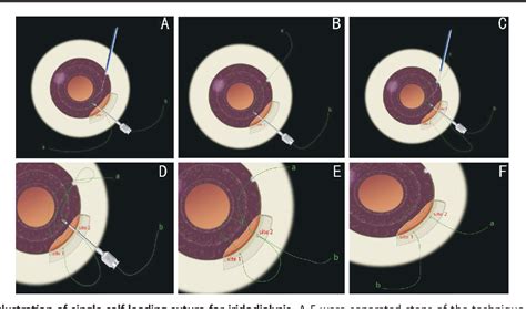 Figure 1 From Single Self Leading Suture Technique For Iridodialysis