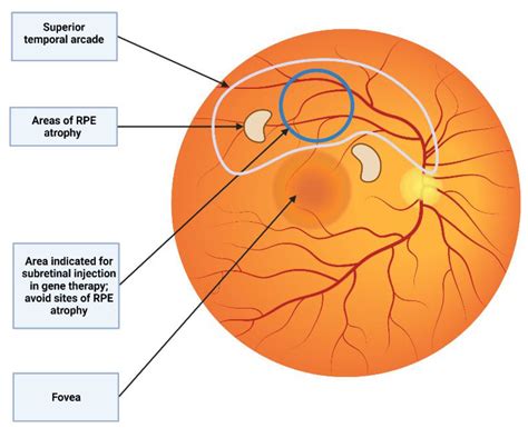 Sub Rpe Hemorrhage