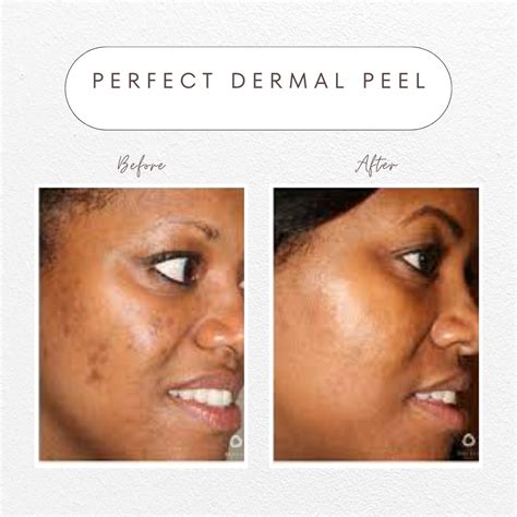 Perfect Dermal Peel Skin Refinement Aspire Care Clinic Chemical