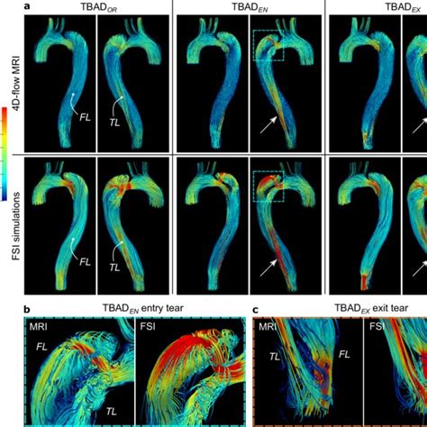 A Streamlines At Peak Systole T 200 Ms Rendered From 4d Flow Mri