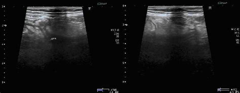 Us Inflamed Appendix In Retrocecal Position Appendix Is Located