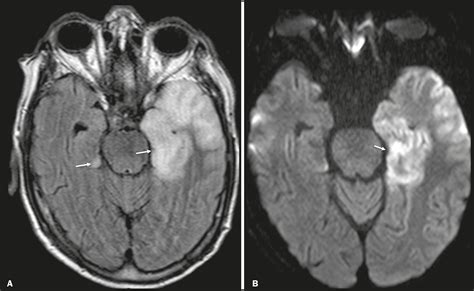 Medial Temporal Lobe Mri