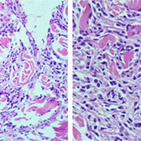 Signet Ring Morphology With Eccentric Nuclei Clear Cytoplasm And