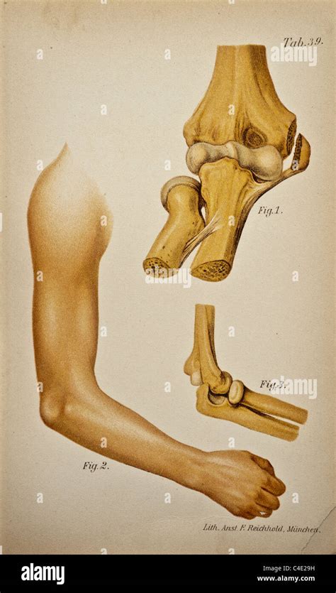 Antique Medical Illustration Of A Dislocated Forearm Circa 1902 Stock