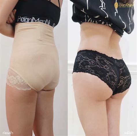 Buttock Augmentation Gallery Lelux Hospital