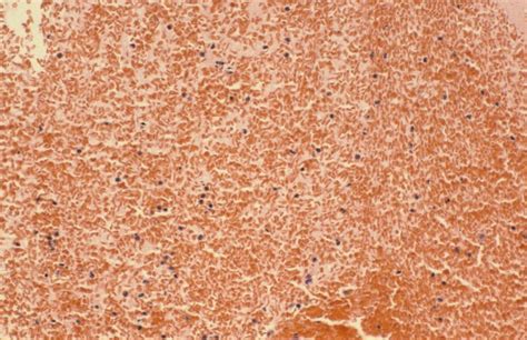 Chapter 4 Decidua Section C Breus Mole Subchorionic Thrombohematoma Fibrin Plaques And