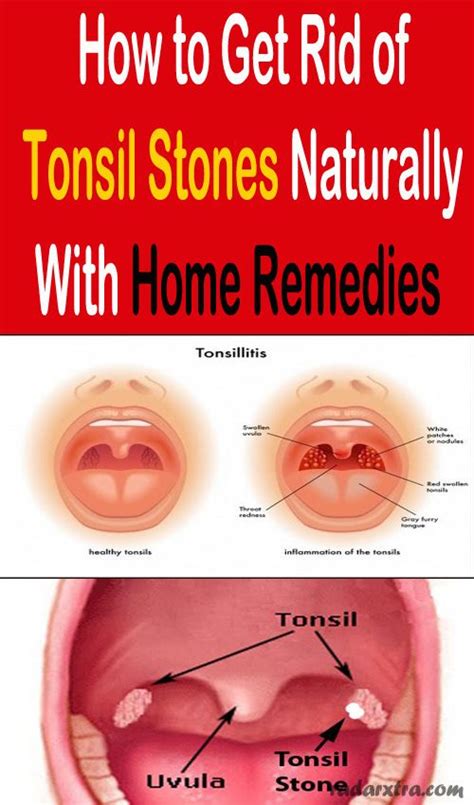 Cure For Tonsillitis Without Antibiotics