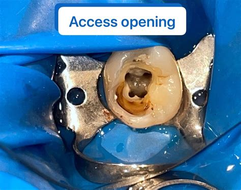 Asma Sherin V T On Linkedin Access Opening Of Molar 36 Under Rubber
