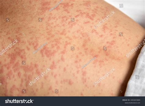 Closeup Red Rash On Human Body Stock Photo Shutterstock