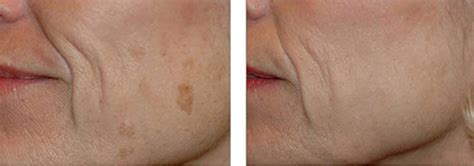 Hollywood Laser Peel Spectra