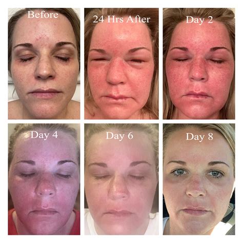 Sciton Halo Hybrid Fractional Laser Dermatology Care Of Charlotte