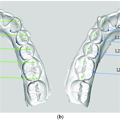 Landmarks And Transverse Parameters On The Buccal And Gingival Side