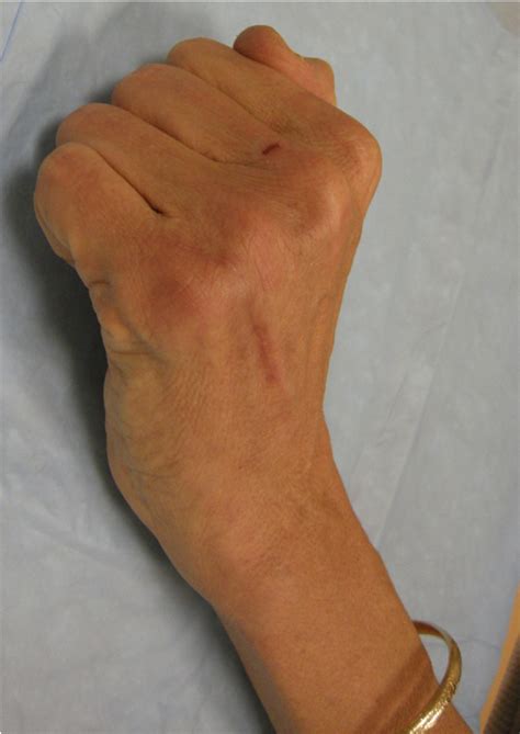 Figure 2 From Intramedullary Cannulated Headless Screw Fixation Of A