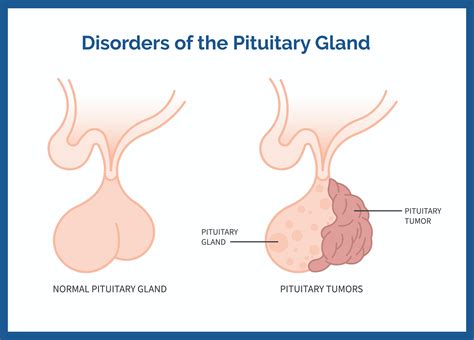 Pituitary Gland Disorders Symptoms And Treatments