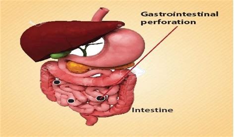 What Is Gastrointestinal Perforation Daily Trust