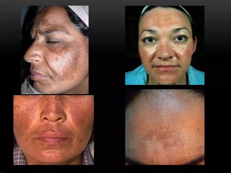 Disorders Of Hyperpigmentation Pptx
