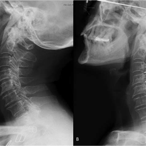 Posterior Cervical Surgery Was Performed To Release The Compression Download Scientific