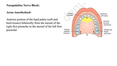 Maxillary Nerve Block Pptx