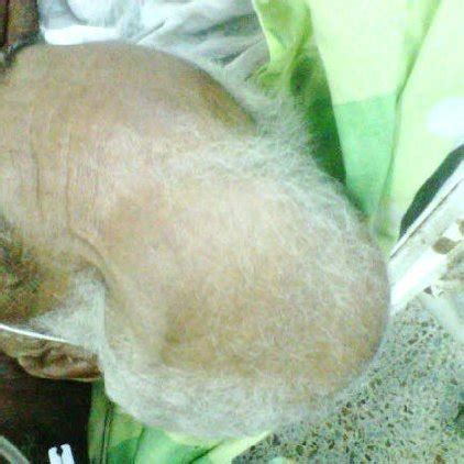 Giant Scalp Swelling Download Scientific Diagram