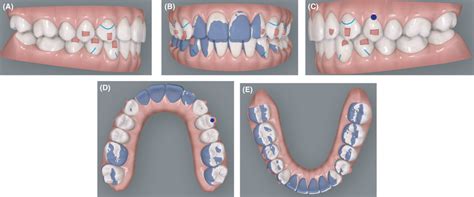 A‐e Intermediate Virtual Projection Download Scientific Diagram