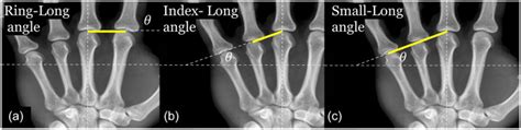 Intramedullary Headless Screw Fixation Of Metacarpal Fractures A Radiographic Analysis For