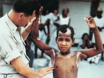 Nuclear Radiation Burns