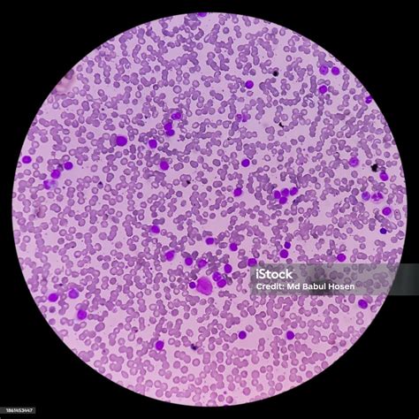 Leukemia Blood Cells Blast Cells And Immature Leukocytic Cells In