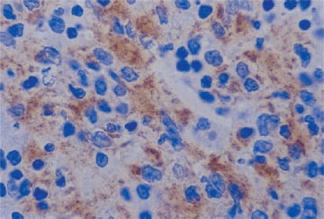 Proteinaceous Lymphadenopathy Basicmedical Key