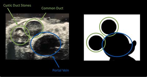 “mickey Mouse Sign” To Identify And Remove Cystic Duct Stones In