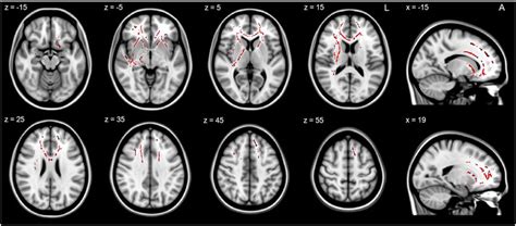 Relationship Of White Matter Microstructure And Negative Symptoms The Download Scientific