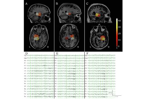 Representative Samples Of Statistical Parametric Mapping Spm Of