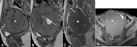 Benign Lesions Fibroid Sagittal T2w A And B T1w C And Axial Post
