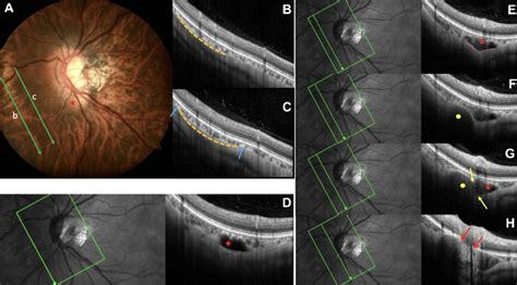 Serial Oct Sections Disclosing The Configuration Of The Posterior Download Scientific Diagram